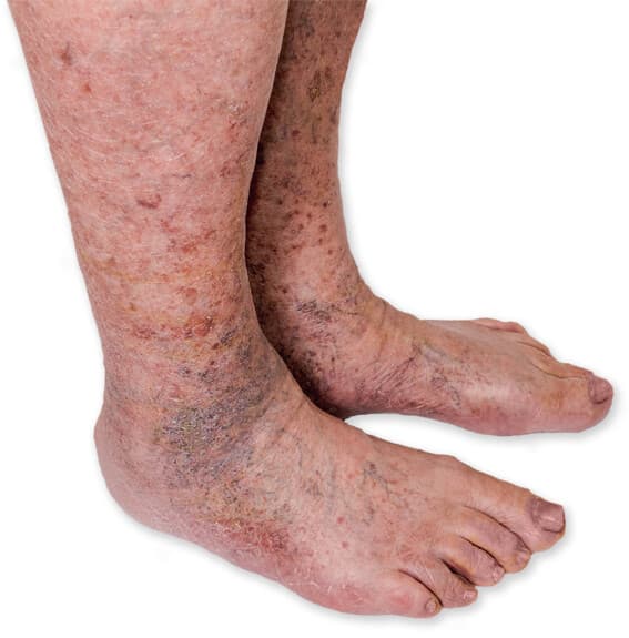 Reddish-brown spot on the shin. What is it? - Dr. Zsolt Zátr